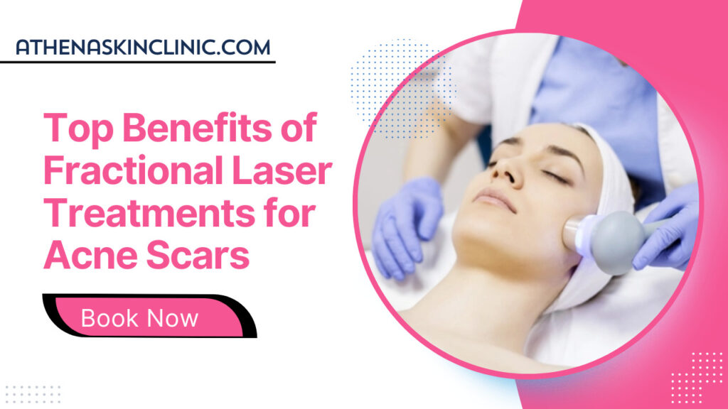 Top Benefits of Fractional Laser Treatments for Acne Scars